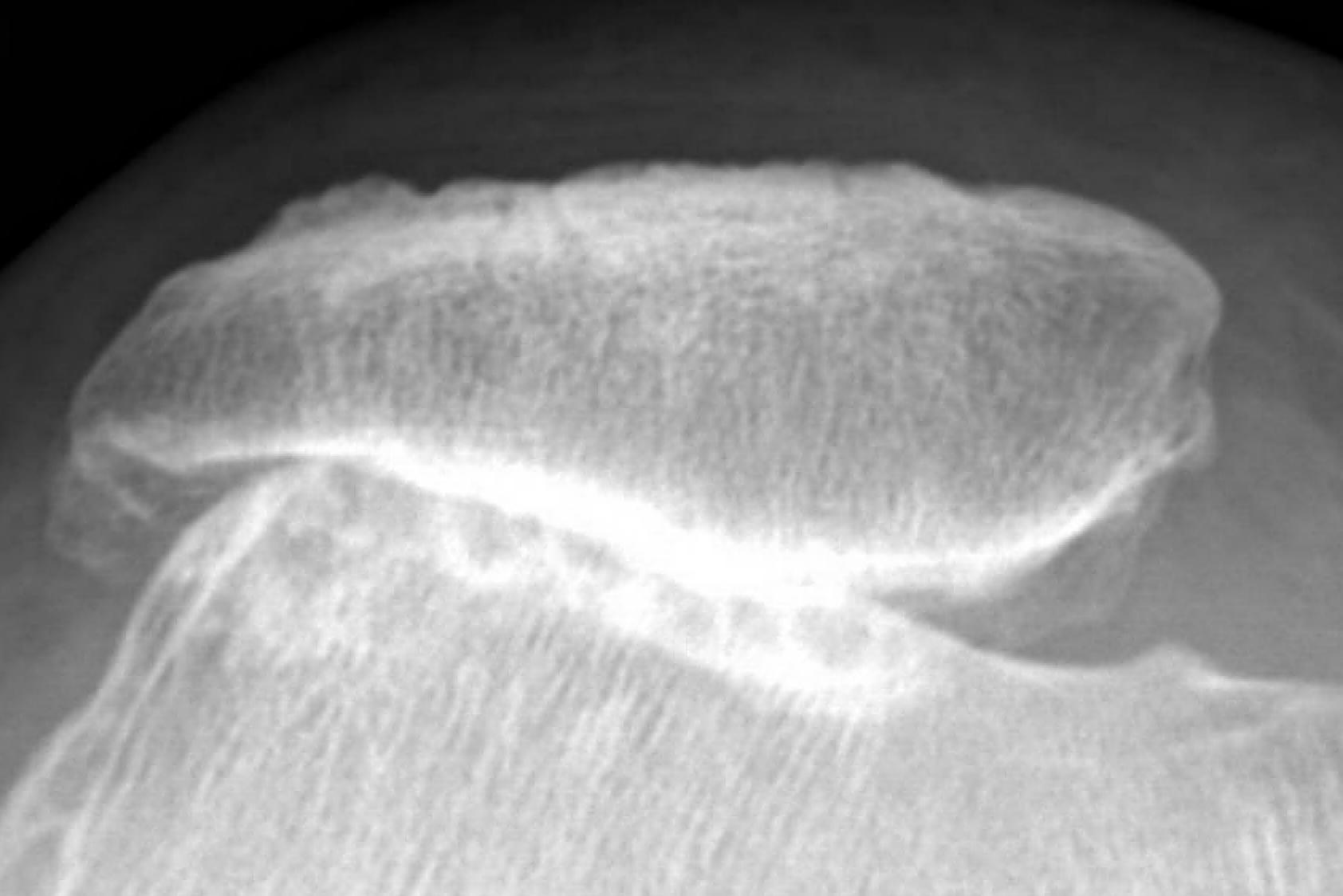 Patella en Rotatie Afwijkingen - Martijn Brinkman, MD PhD